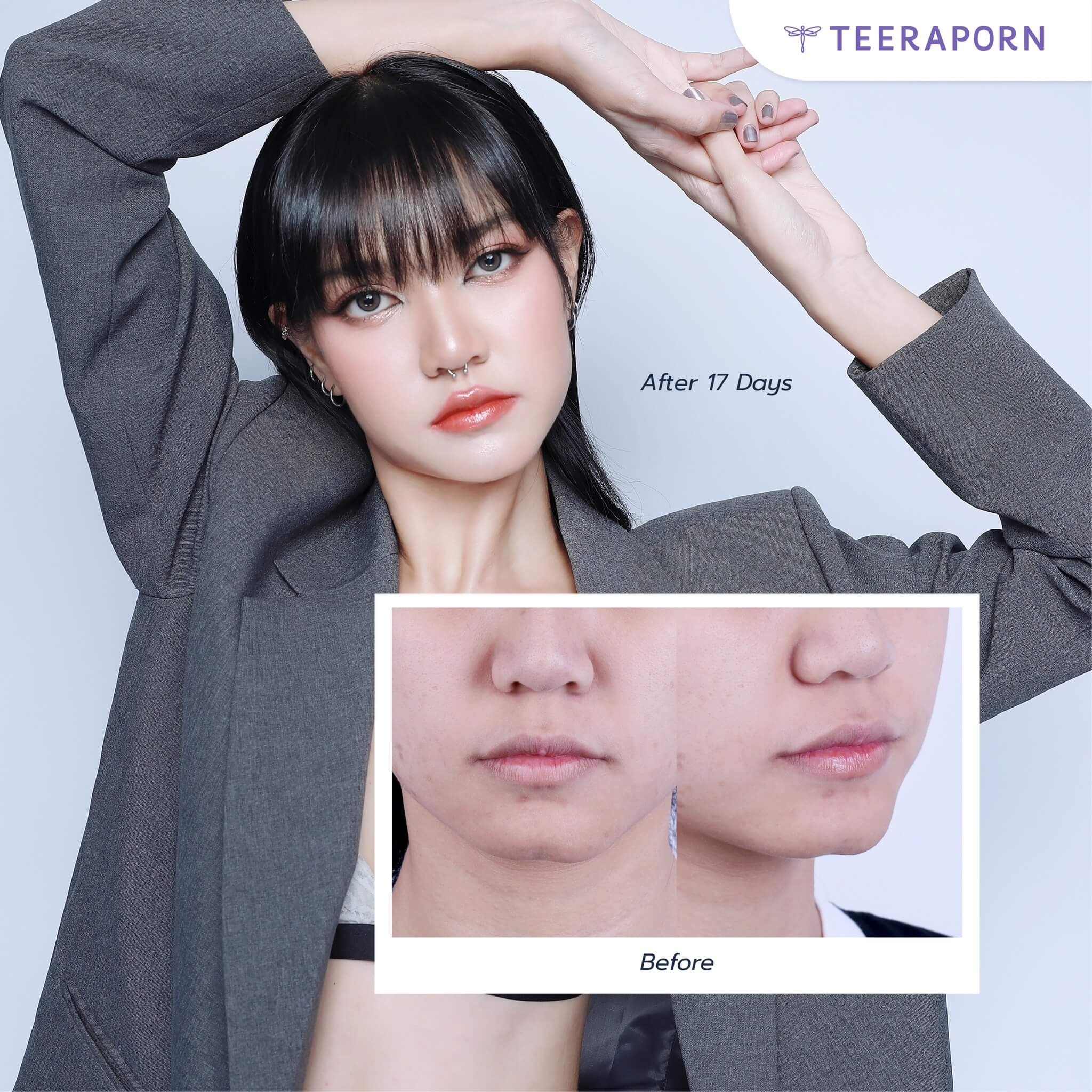 Safe and Long-lasting Chin Augmentation with Multi Cell | TRP Hospital