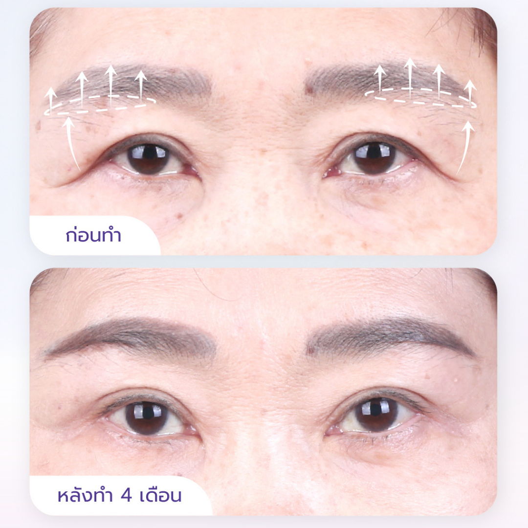 Subbrow เก็บหนังใต้คิ้ว ด้วยวิธีซ่อนรอยแผล ที่ - TEERAPORN